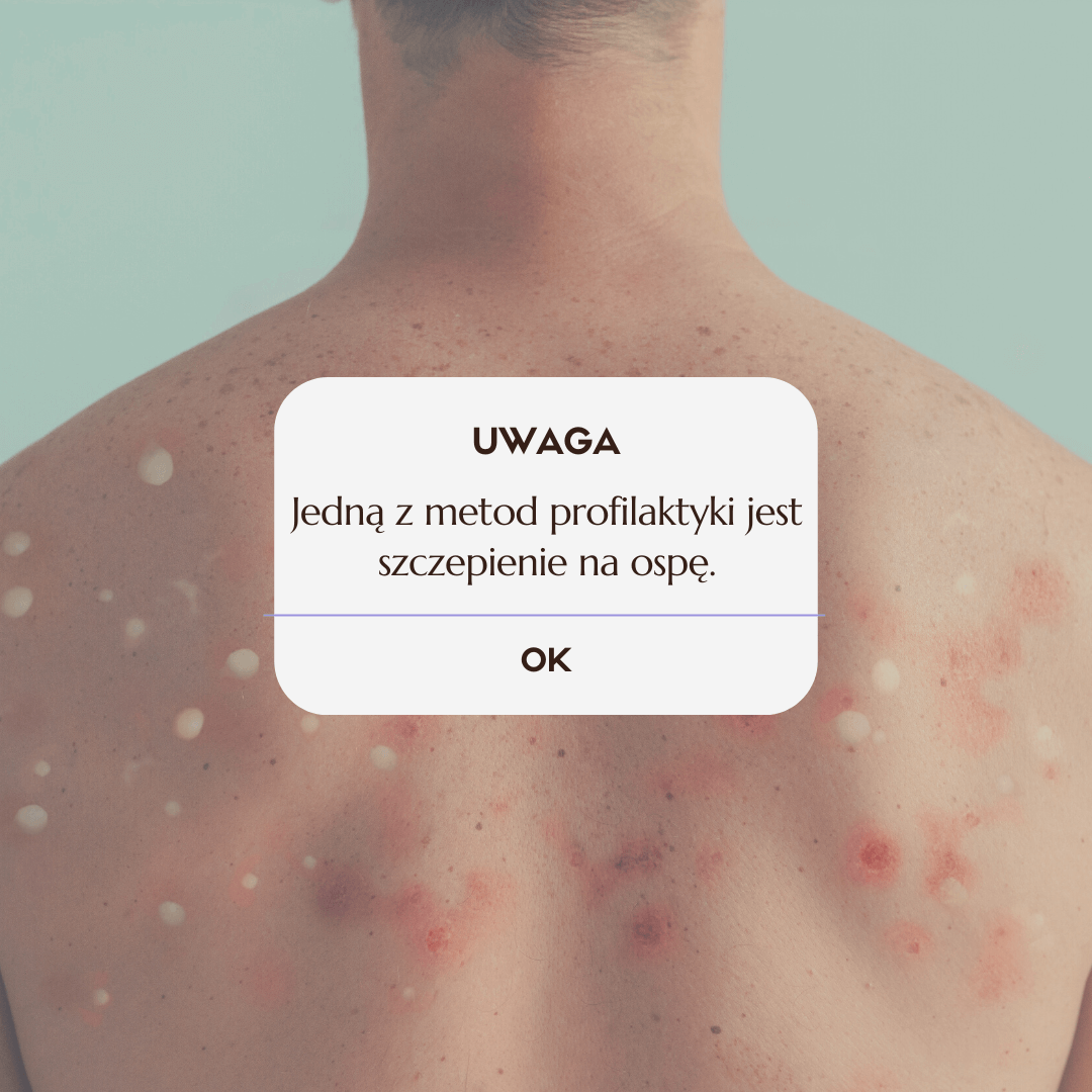 Ospa dzień po dniu – przebieg, powikłania ospy wietrznej • Ratownik ...